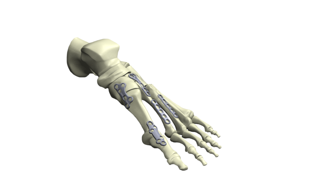 ATLAS™ Plates - MiRus