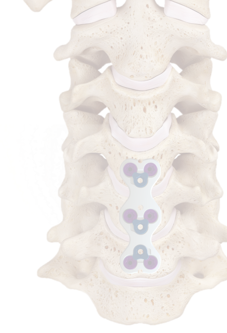 CYGNUS MoRe® Anterior Cervical Plate System - MiRus