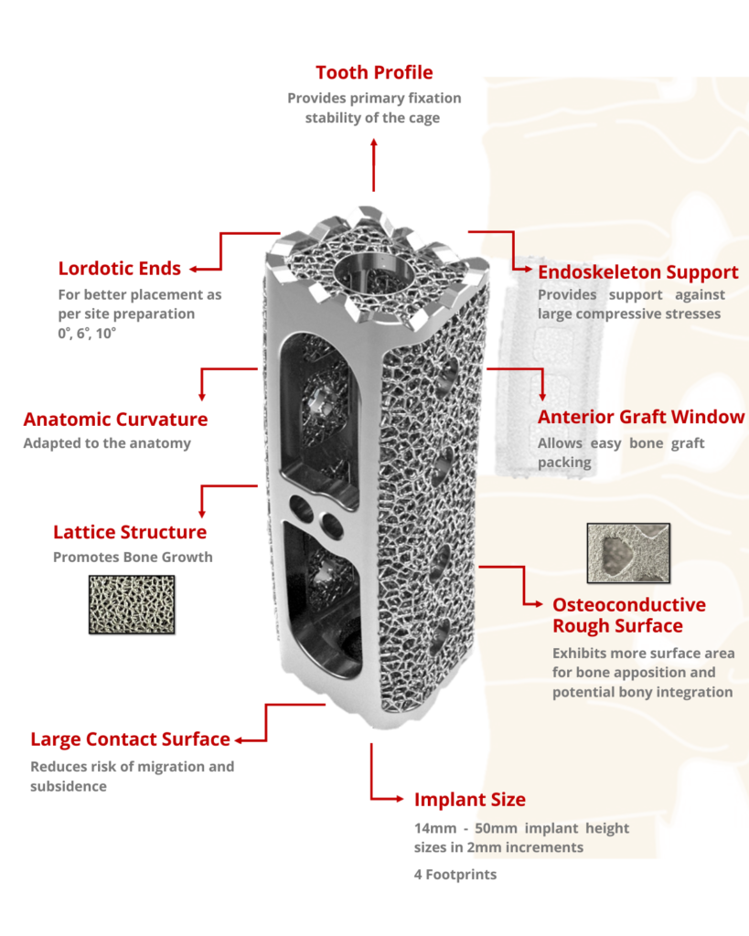 RIGEL 3DR™ Cervical Corpectomy System - MiRus