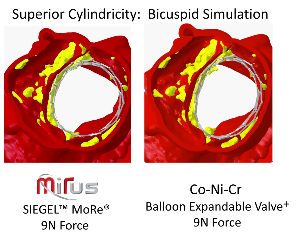 SIEGEL™ Transcatheter Aortic Valve - MiRus