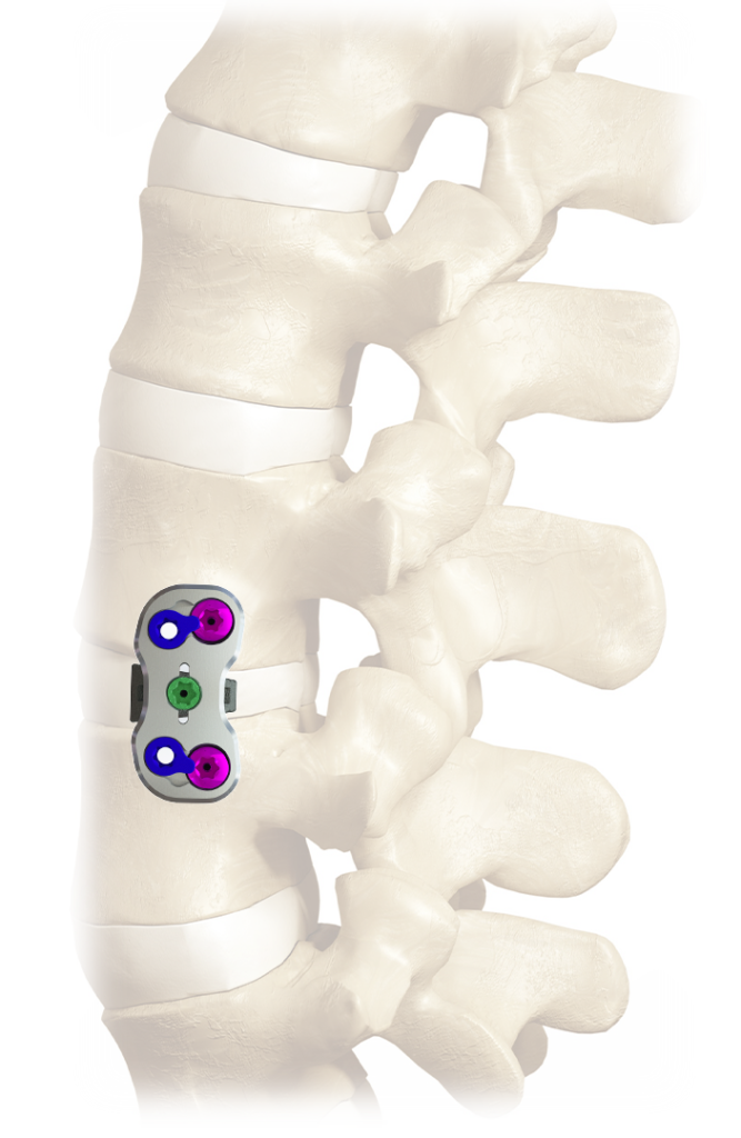 MoRe® Lumbar Plates - MiRus